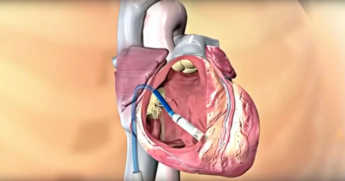 SJD Barcelona Children’s Hospital implants the first wireless pacemaker ...